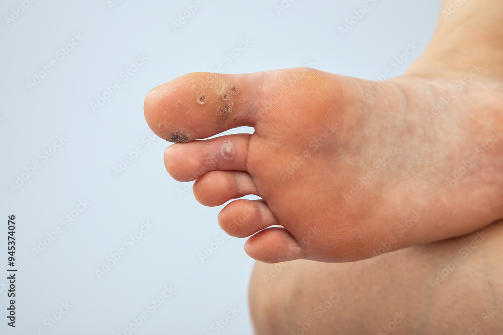 Girl applying ointment to a wart on her toe. Treatment of plantar warts ...