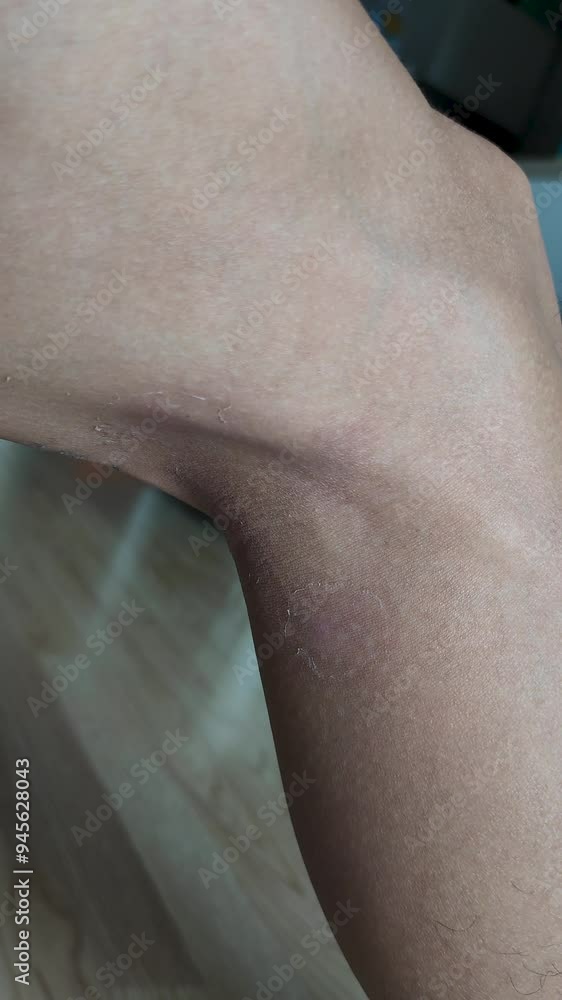 Paederus dermatitis, medically known as dermatitis linearis. You will ...