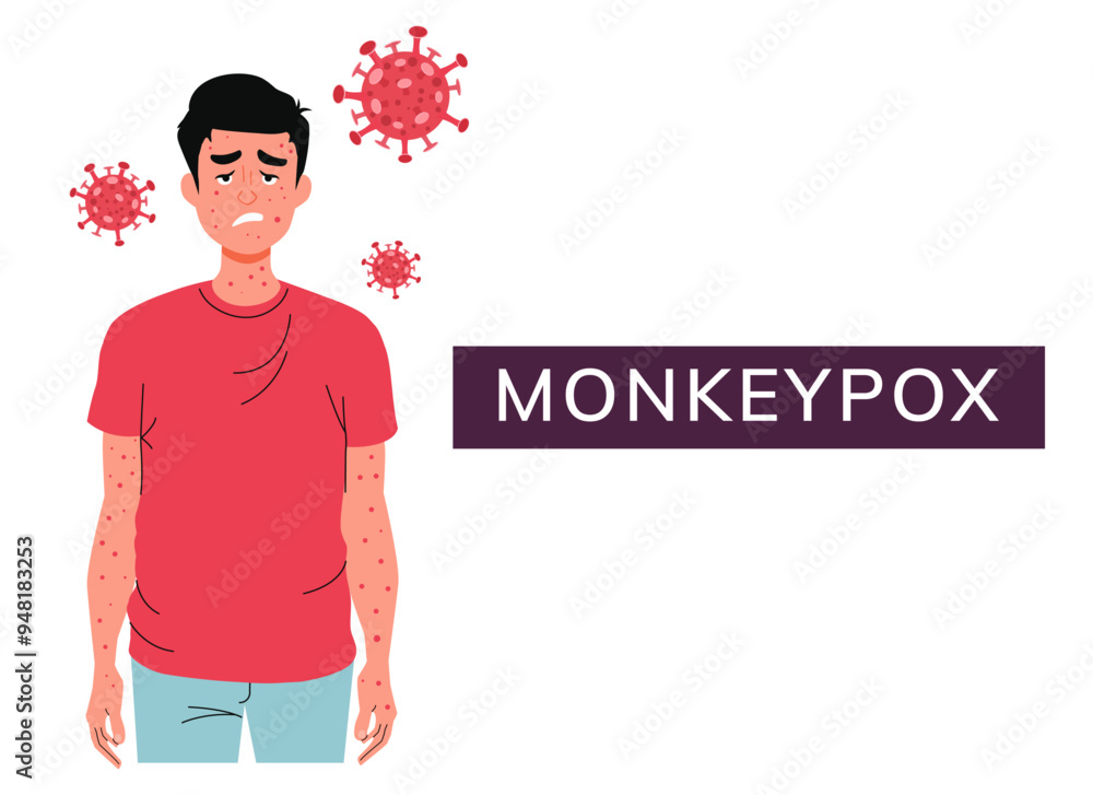 Monkeypox. World virus. Symptoms disease. Medical. Fever, chills ...