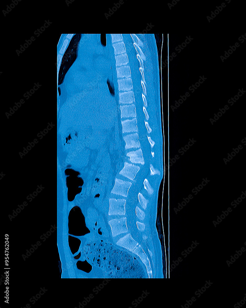 X ray of the human spine fracture. Lumbar spine radiograph Stock Photo ...