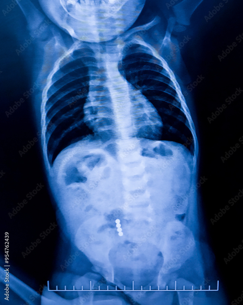 X-ray of a small child who swallowed 4 round magnets. Image of magnets ...