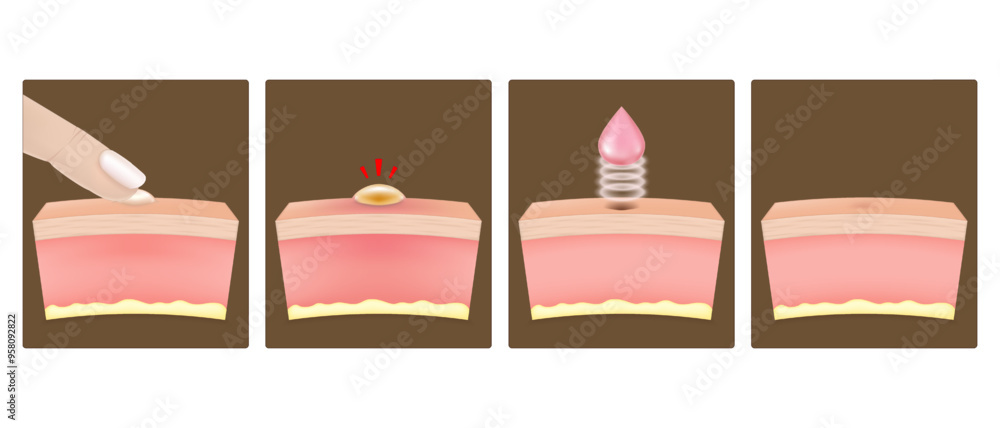 Poster Process of squeezing acne with fingers until a large inflamed ...