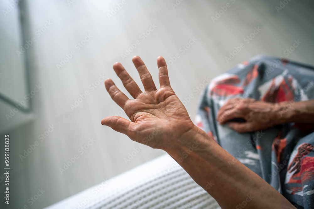 Dupuytren contracture, bulge on palm. Mature woman showing hand with ...