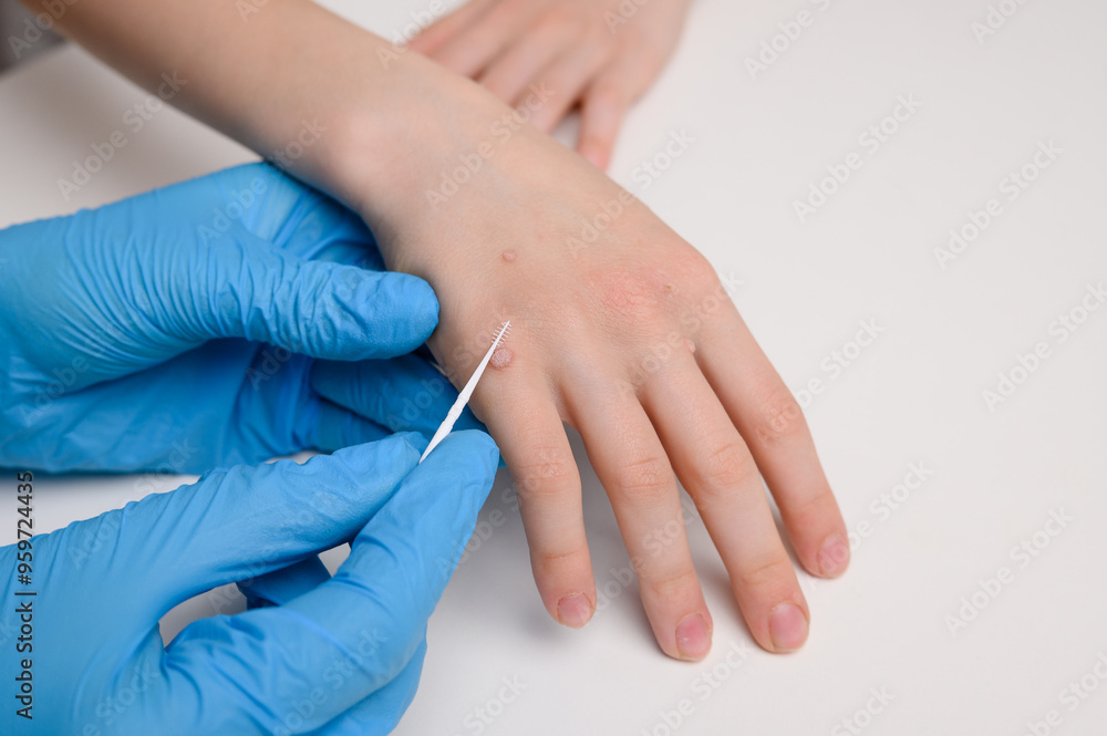 Child undergoing treatment for warts. Doctor removing wart from hand ...