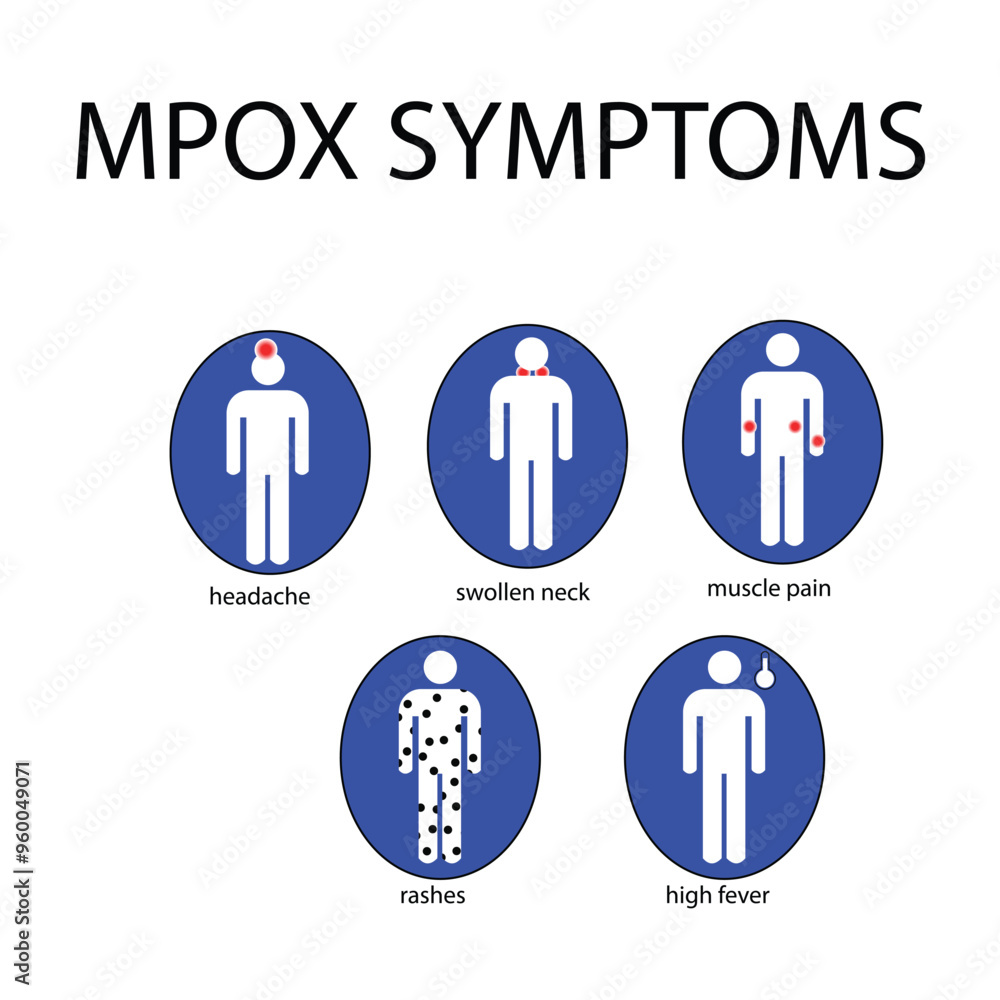 A Posture design explaining the symptoms of MPOX virus disease Stock ...