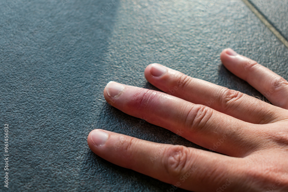 Mallet finger healing after splint removal from middle finger following ...