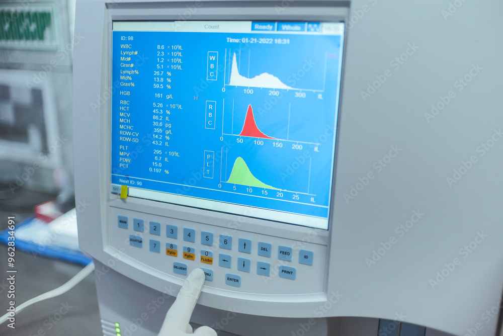 A hematology analyzer machine displaying blood test results of a ...
