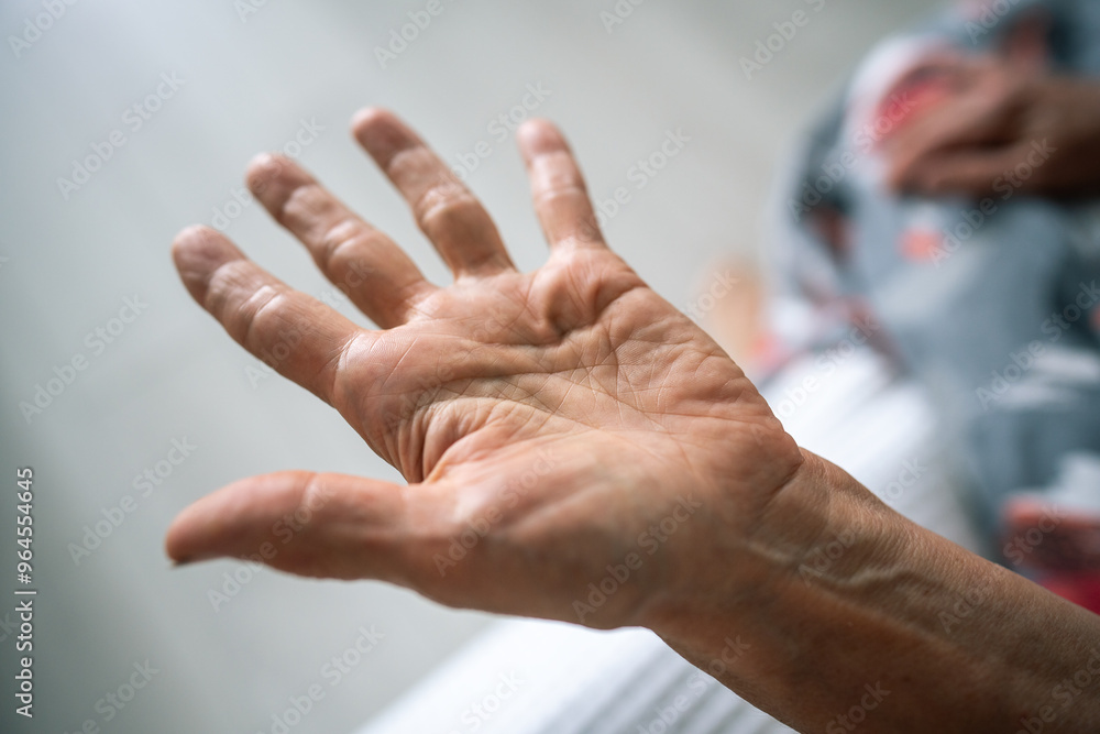 Dupuytren contracture and bulge on palm, closeup. Mature woman hand ...