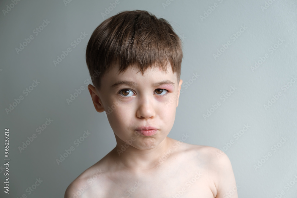 Portrait of angry 6 year boy with red swollen eye isolated on grey ...