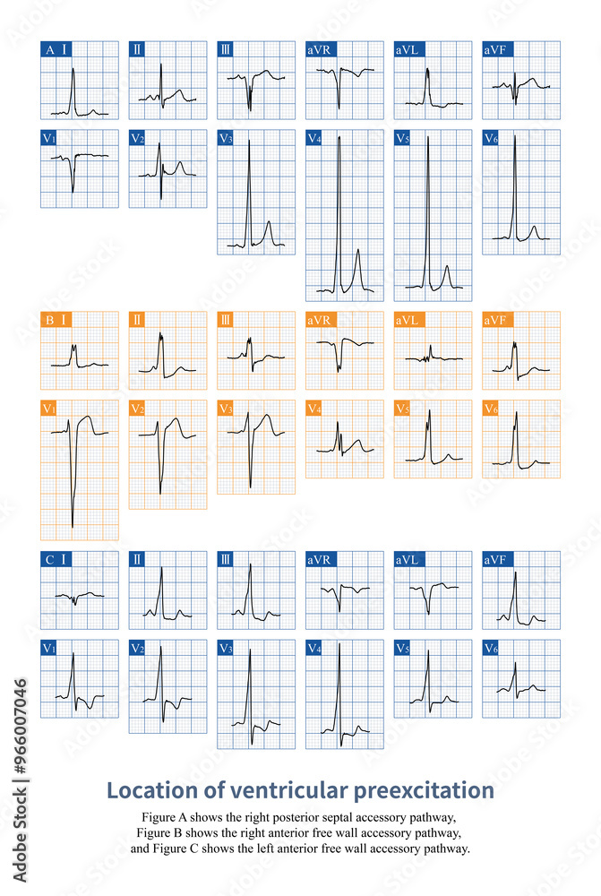 Poster On the electrocardiogram, observing the morphology of QRS waves ...