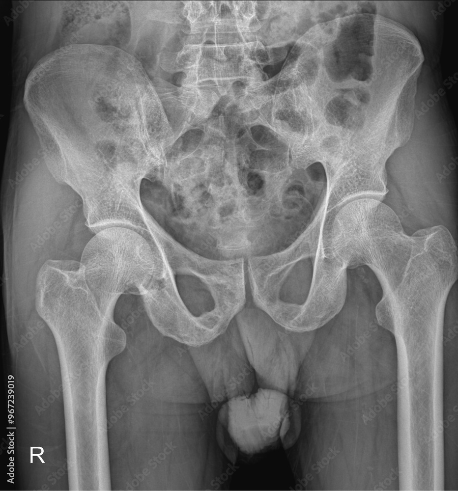 X-ray of Both Hips: AP Projection for Bone Density Analysis Stock 写真 ...