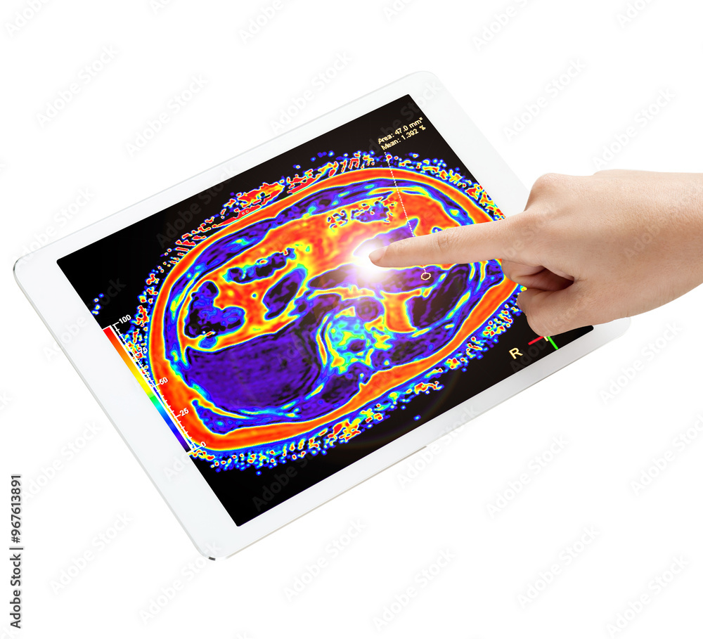 Póster The tablet reveals high-resolution detailed MRI PET scan of the ...