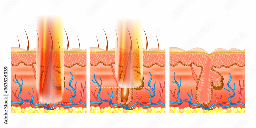 Laser hair removal. Depth of penetration by various lasers. Depth of ...