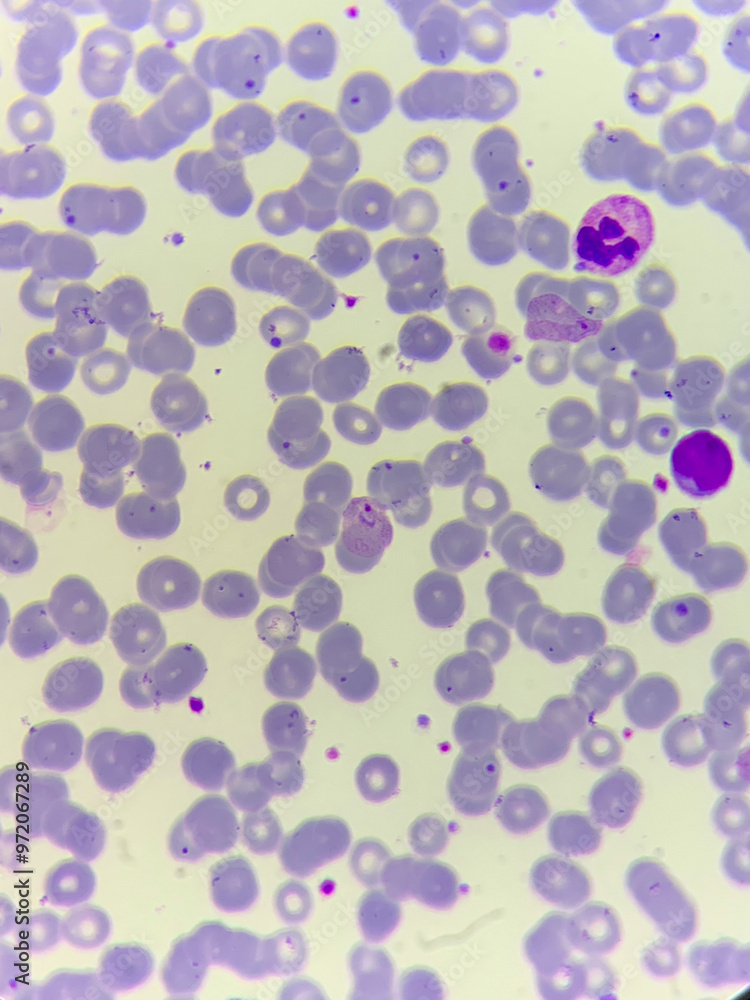 A smear of human blood under a microscope. Blood cells, red blood cells ...