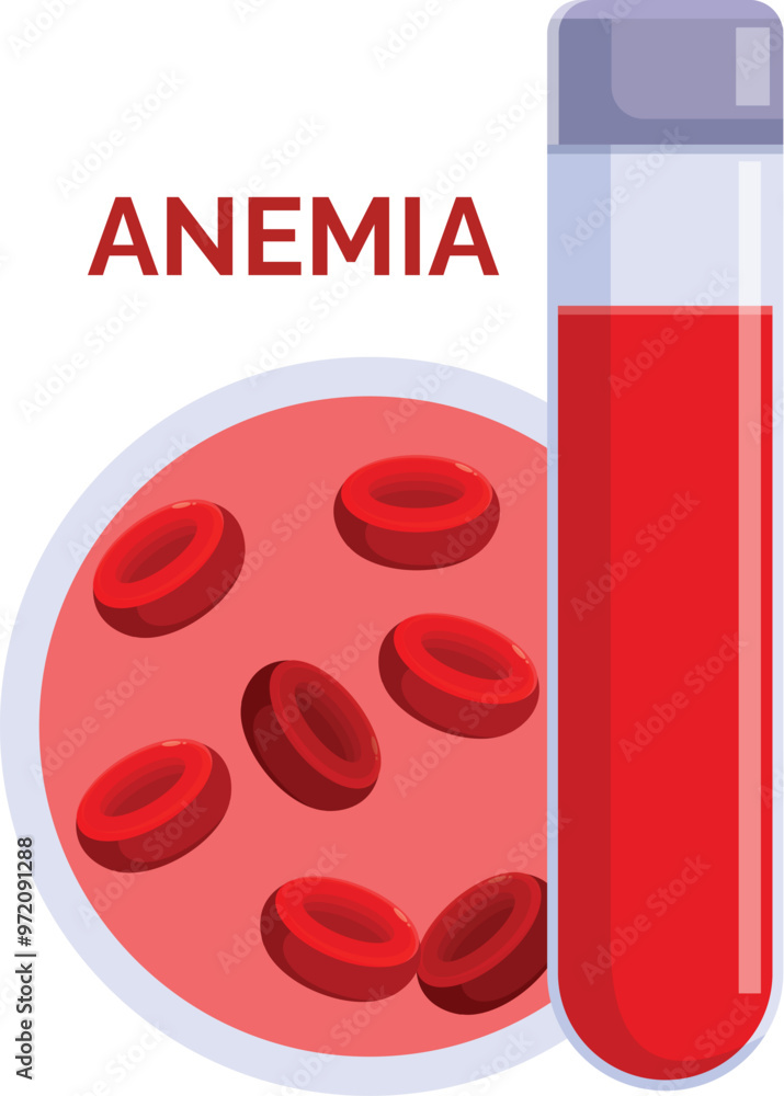 Medical illustration showing a blood test with a low red blood cell ...