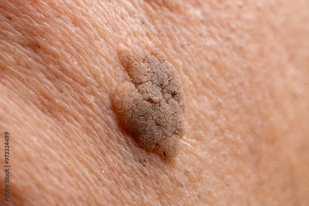 Close-Up of Brown Seborrheic Keratosis (Seborrhoeic wart, Basal cell ...