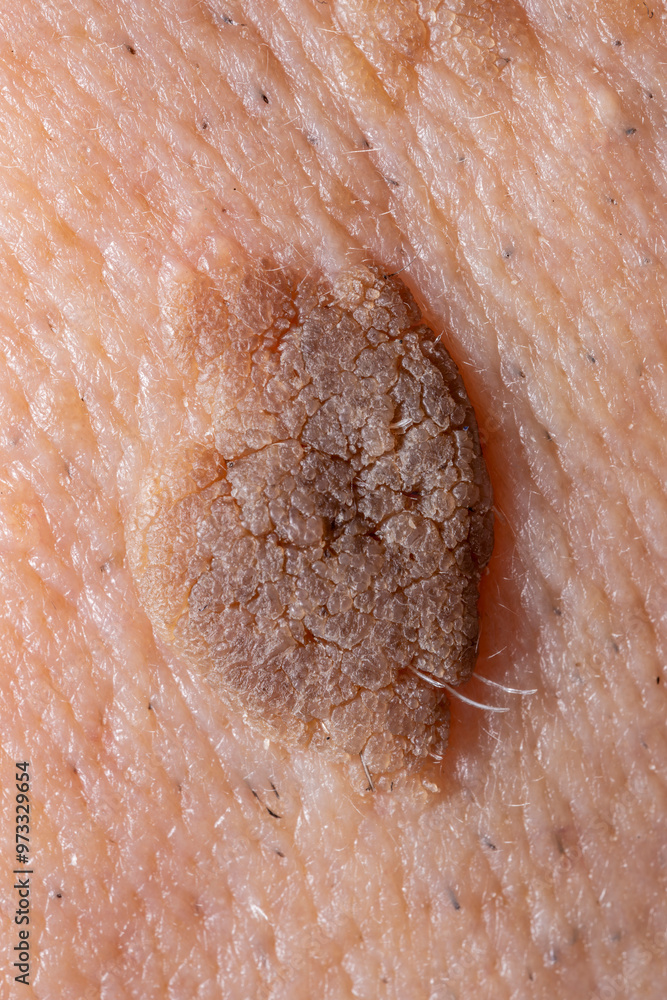 Close-Up of Brown Seborrheic Keratosis (Seborrhoeic wart, Basal cell ...