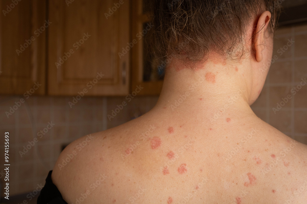 Psoriasis. Psoriasis plaques on a girl’s head. Itching and. rash on the ...