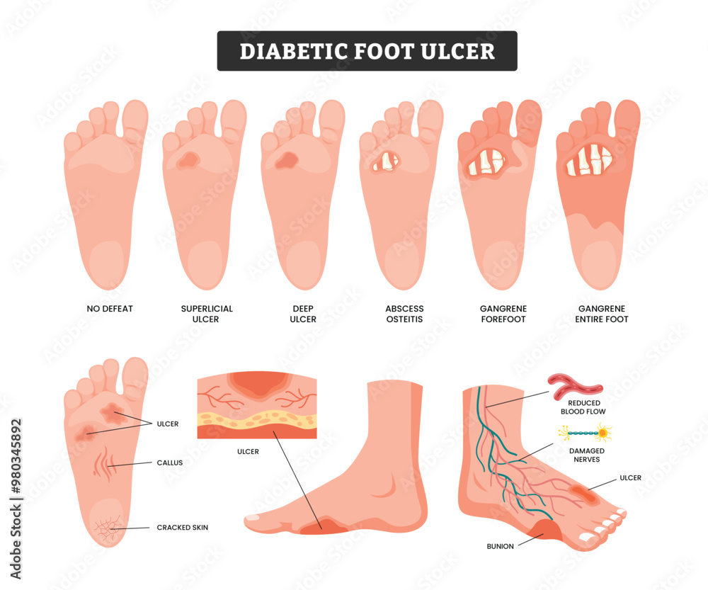Set of Diabetic Food Ulcer medical infographic healthcare poster design ...