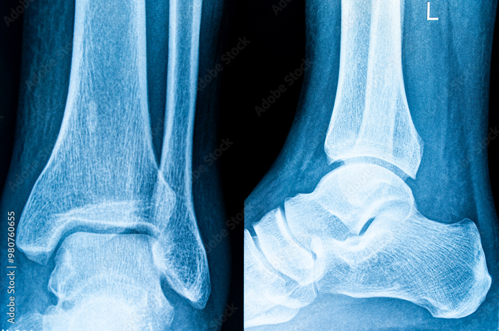 X-ray images of a human left knee joint in lateral and frontal views ...