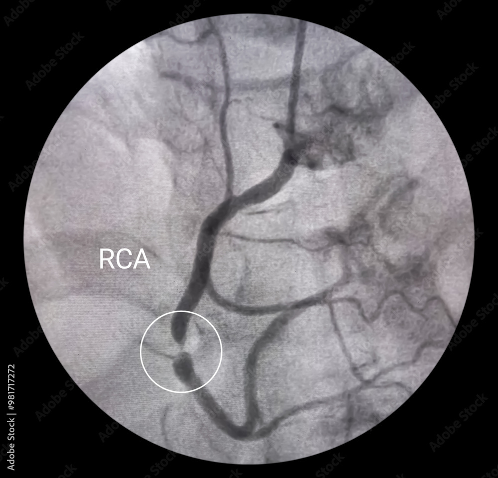 Coronary angiogram of right coronary artery during cardiac ...