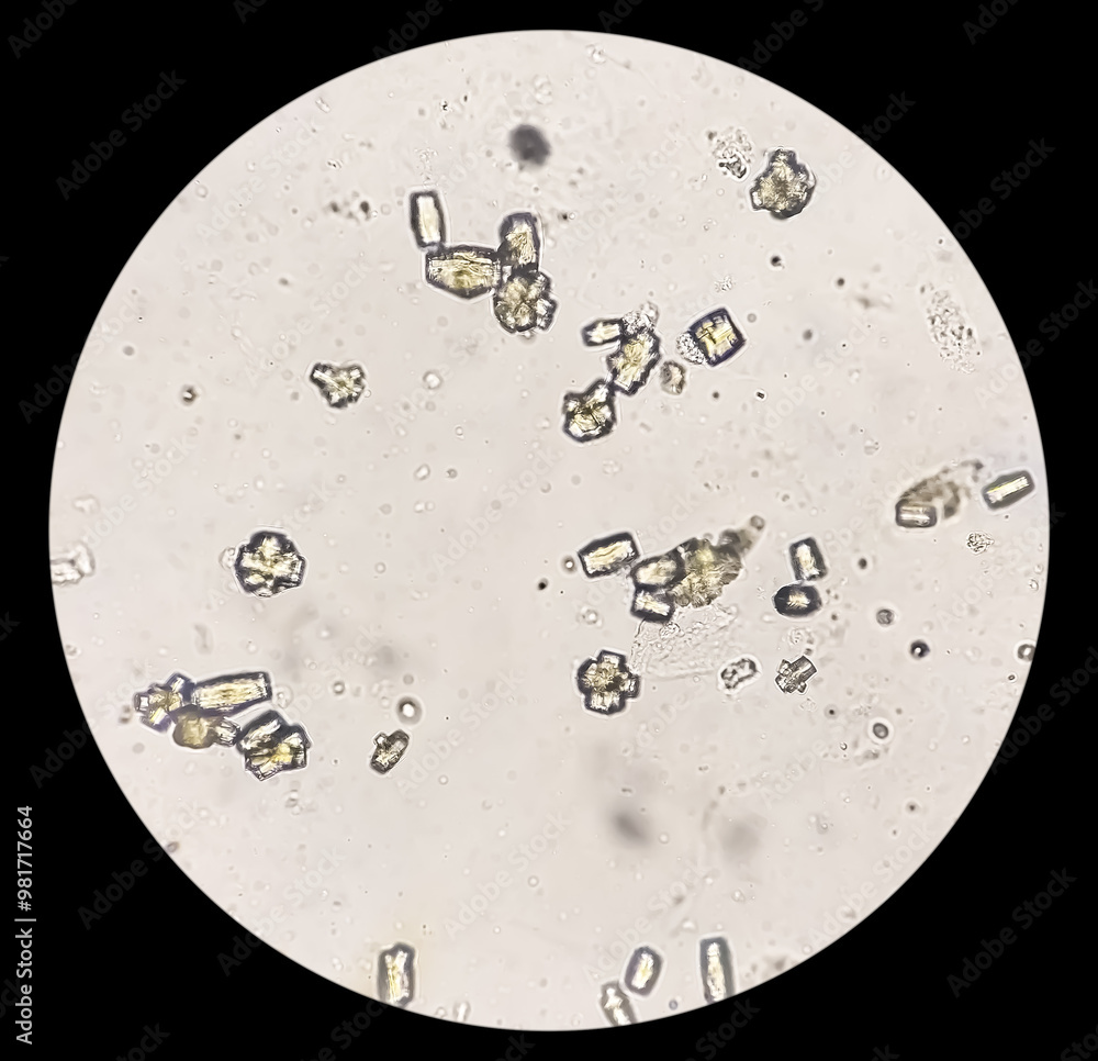 Microscopic image showing calcium oxalate monohydrate, uric acid ...