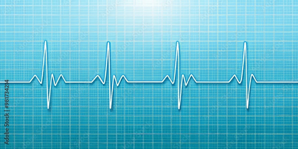 A vector graphic of a first-degree atrioventricular block ECG waveform ...