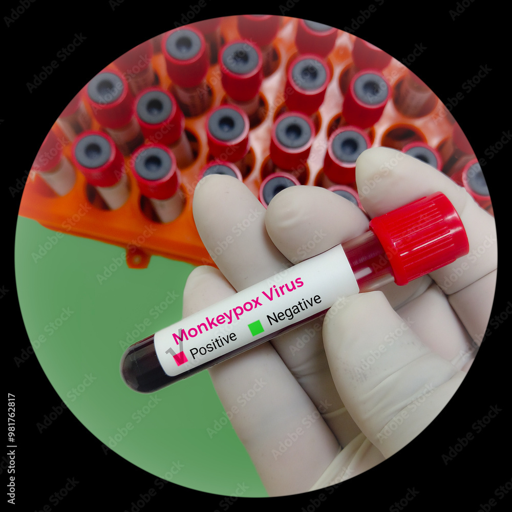 Blood sample for monkey pox virus (MPXV) test. Mpox (formerly known as ...