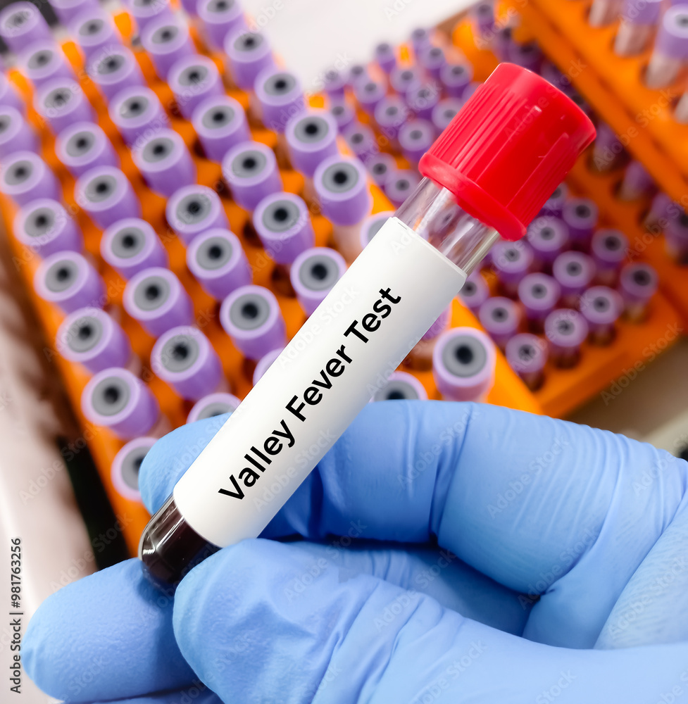 Valley fever disease test.Coccidioides precipitin, a blood test that ...