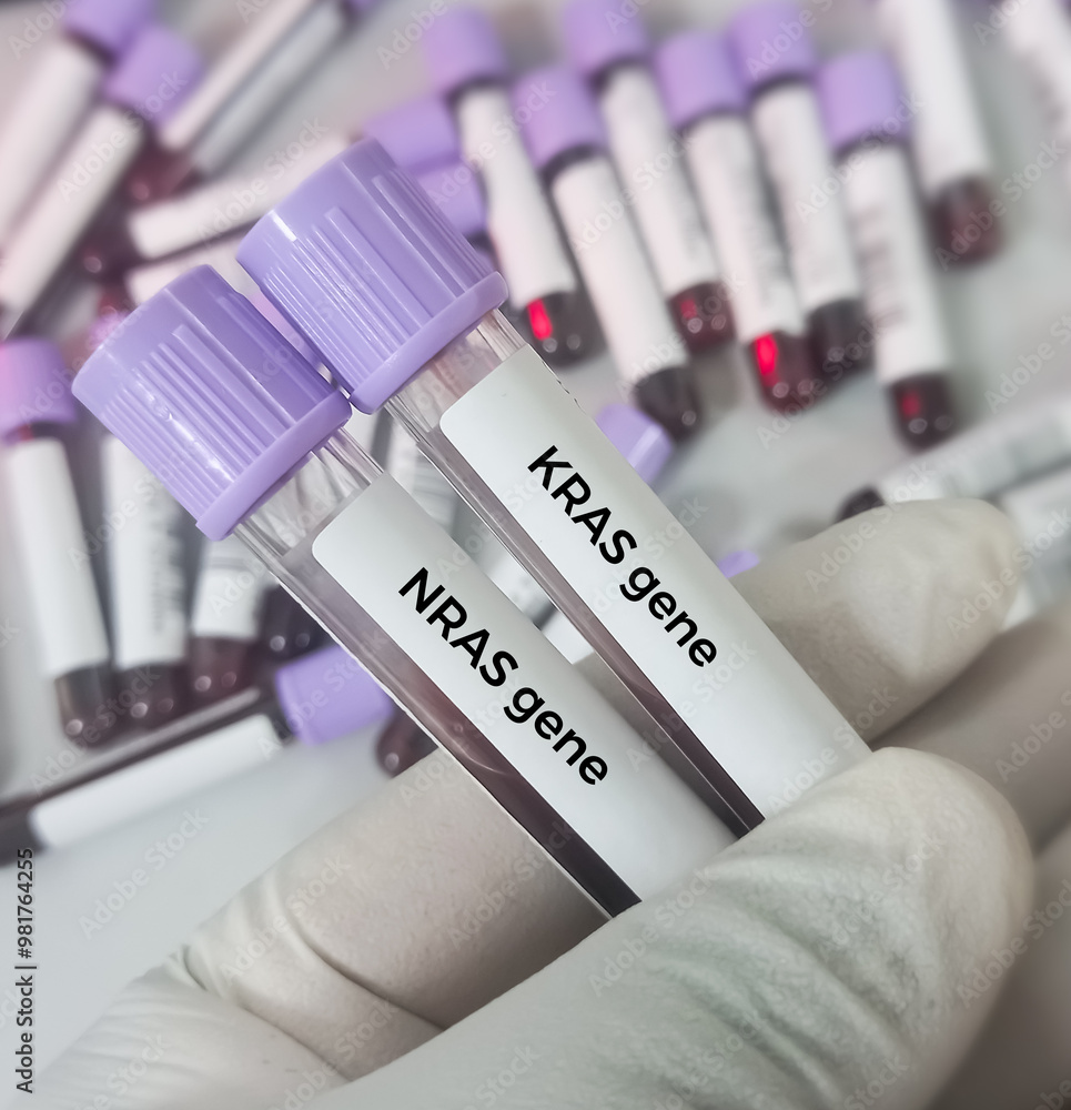 Blood sample for HRAS gene (KRAS and NRAS) test. Costello syndrome ...