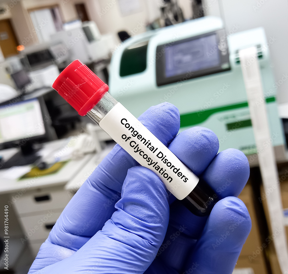 Congenital Disorders of Glycosylation (CDG), a large group of rare ...