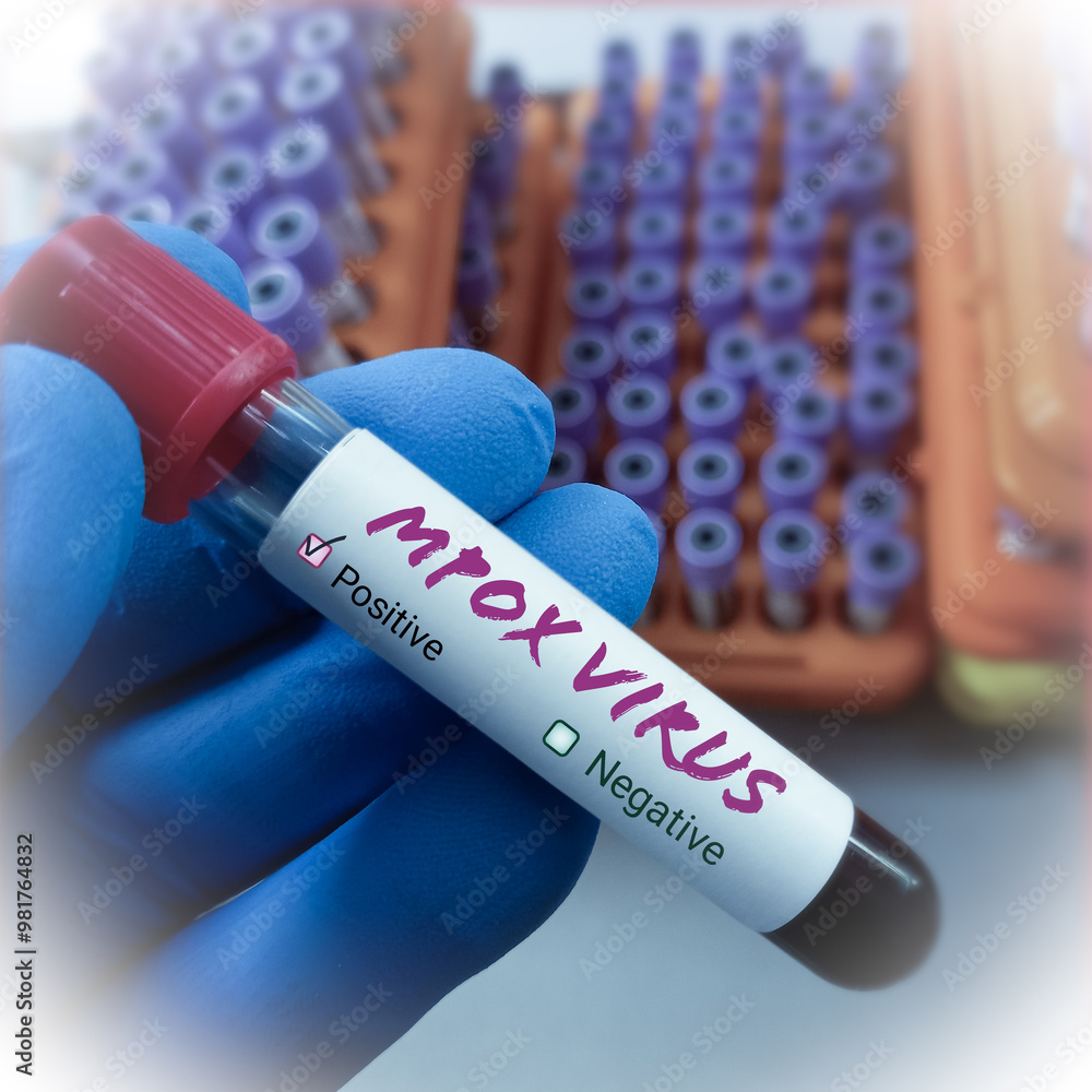 Blood sample for monkey pox virus (MPXV) test. Mpox (formerly known as ...