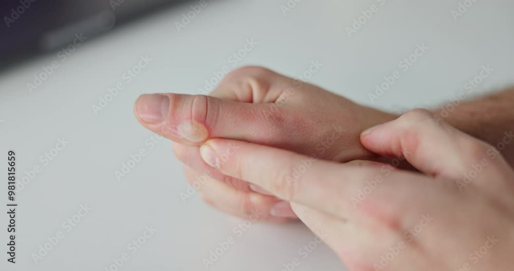 Hands, boil and dermatology with swelling, man and inflammation with ...