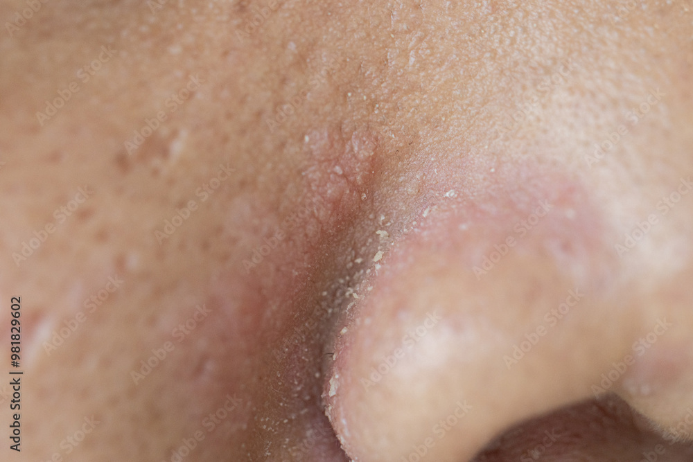 Scalp fungal infection that causes skin disease at the head, skin on ...