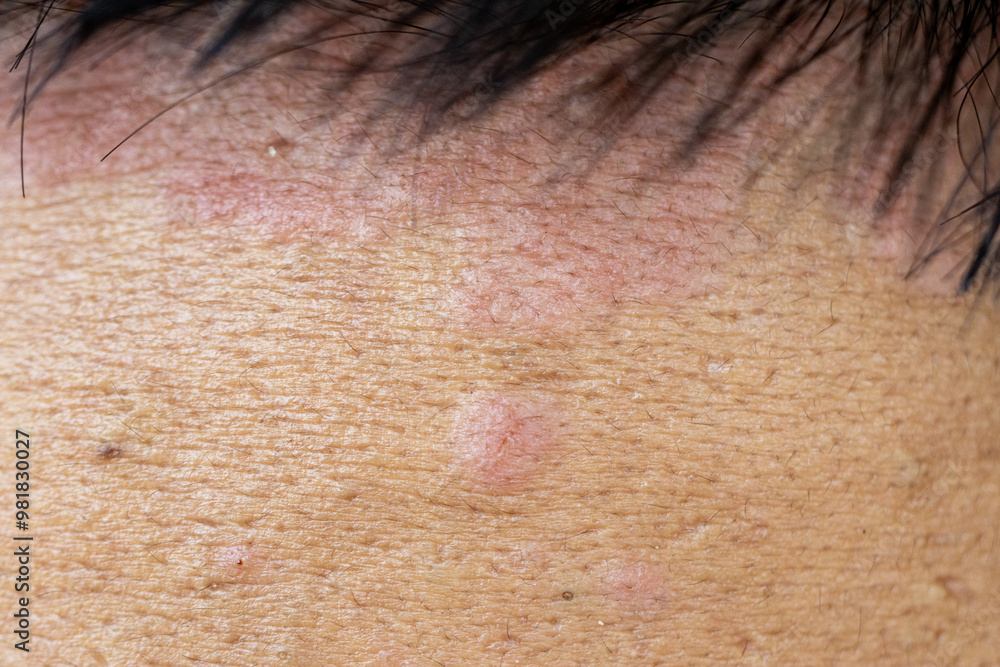 Scalp fungal infection that causes skin disease at the head, skin on ...