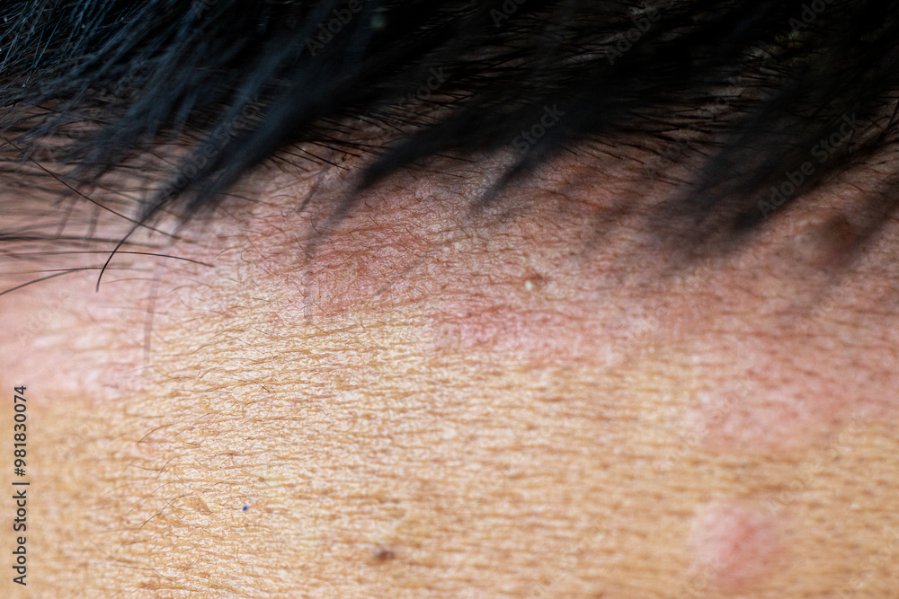 Scalp fungal infection that causes skin disease at the head, skin on ...