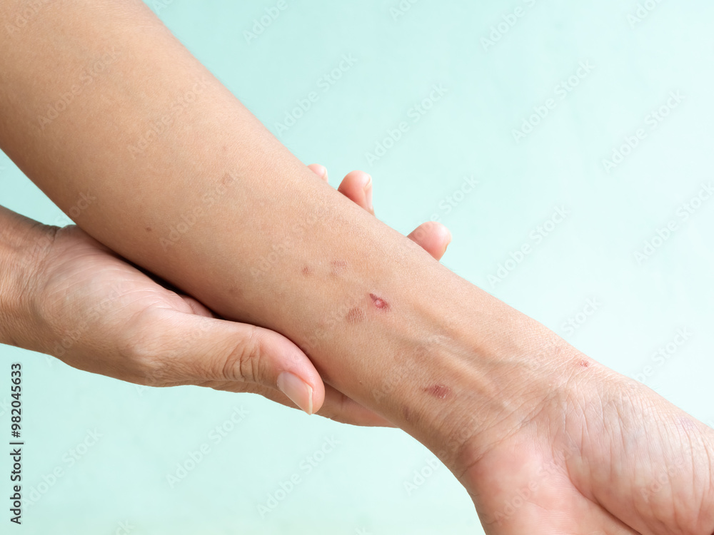 Hand with urticaria allergy itchy rash eczema itch woman from food ...