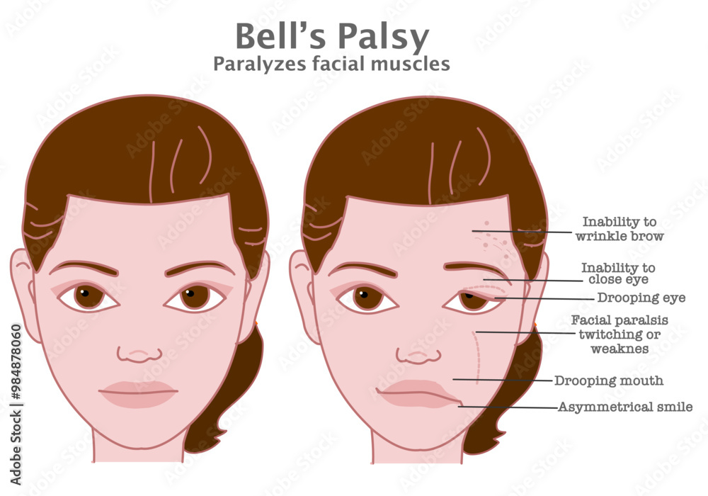 Bell palsy. Facial muscle paralysis. Drooping, close eyes. twitching ...