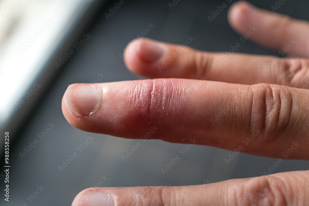 Mallet finger healing after splint removal from middle finger following ...