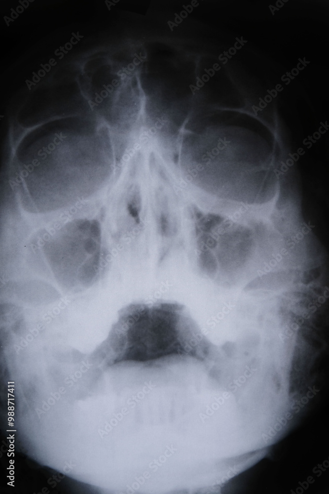 X-ray of the nasal sinuses close-up, diagnostics of sinusitis close-up ...