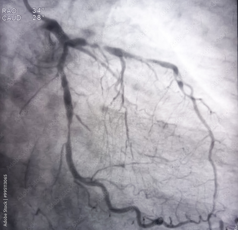 Coronary angiogram of left coronary artery during cardiac ...