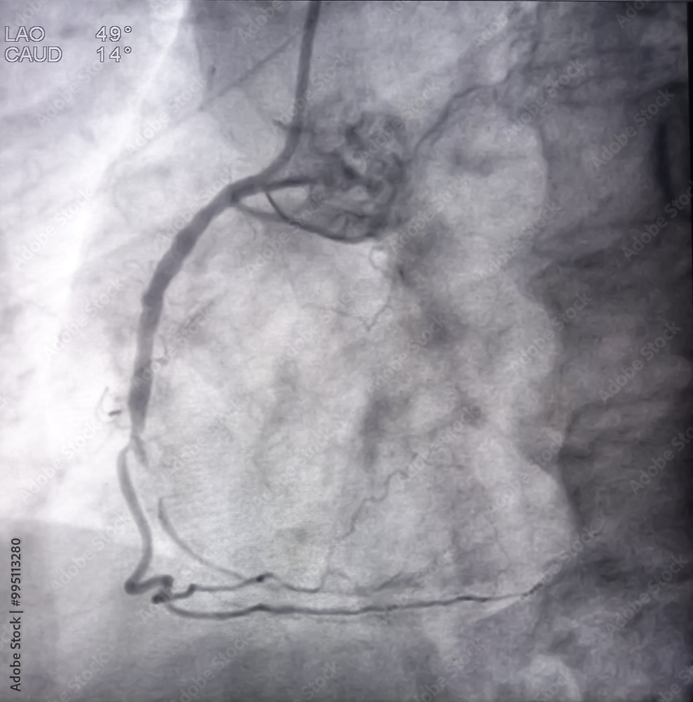 Coronary angiogram of right coronary artery during cardiac ...