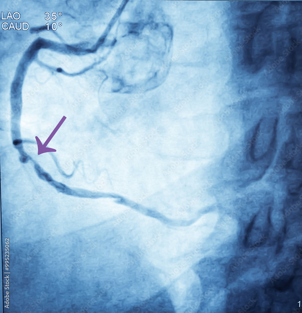 Coronary angiogram of right coronary artery during cardiac ...