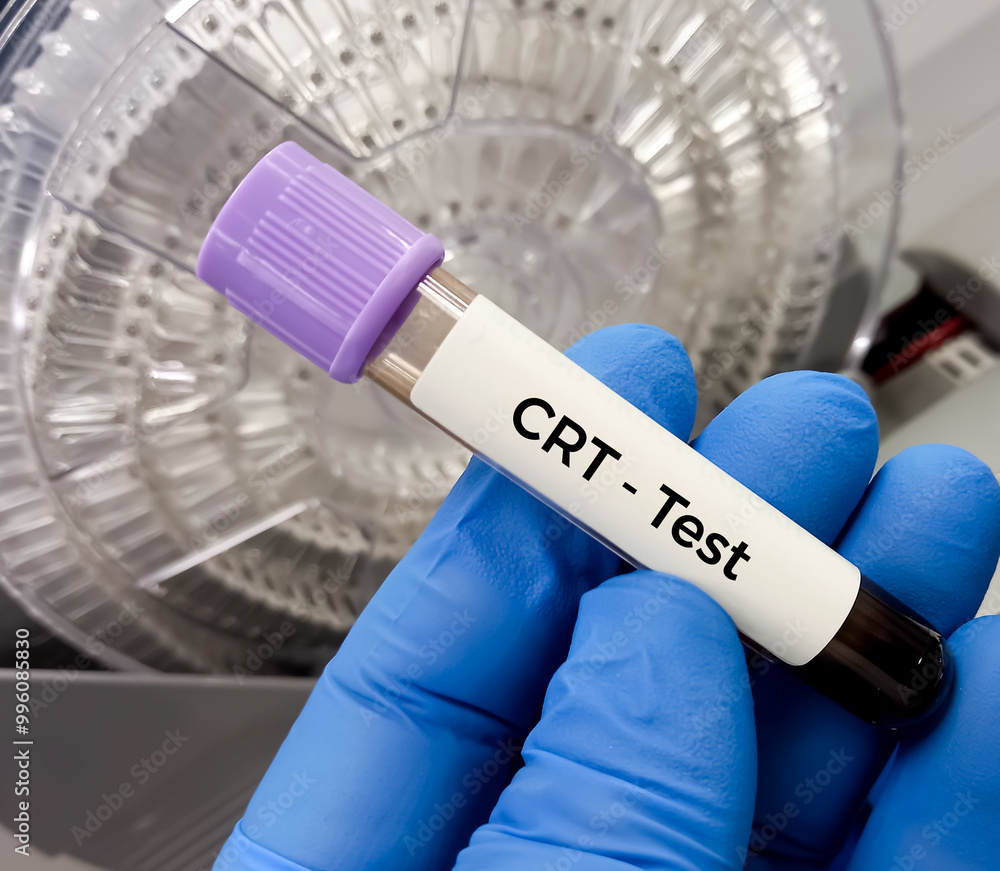 Blood sample for clot retraction test, to measures the time taken for a ...
