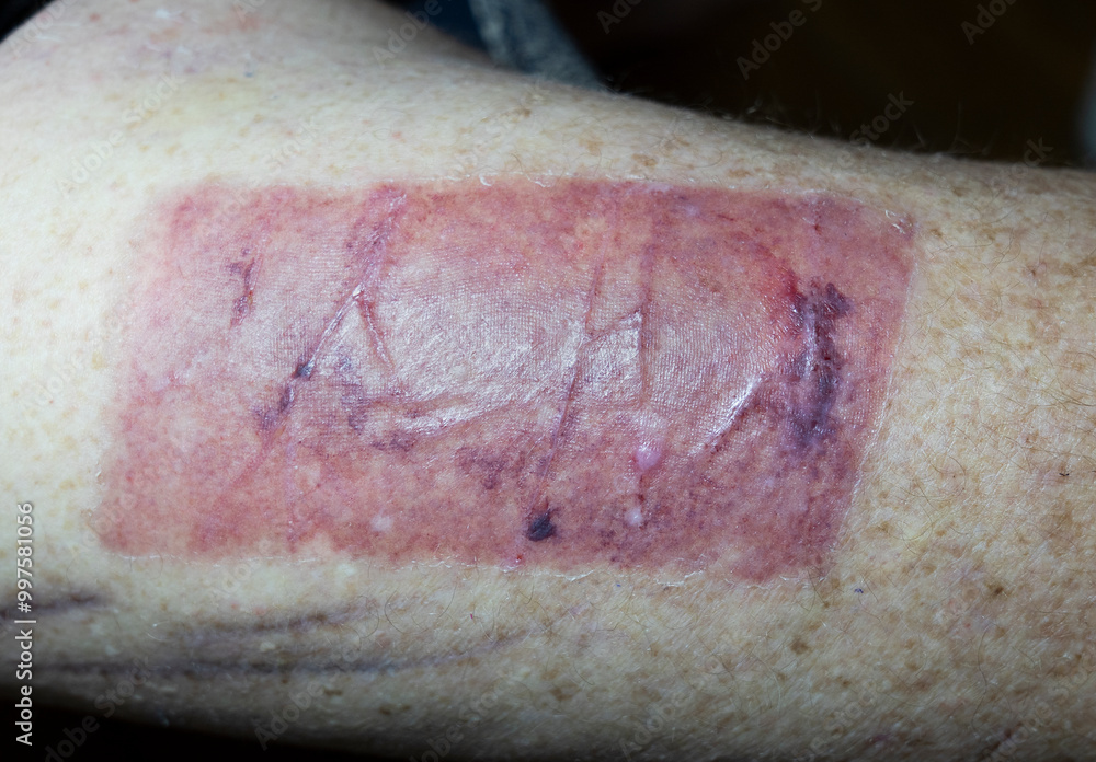 Skin graft donor site on the thigh of a senior male having surgery for a skin cancer. Stock ...