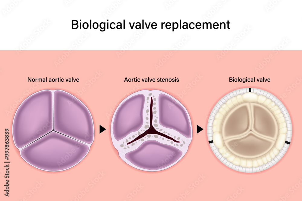 Aortic valve replacement. Normal aortic valve. Aortic valve stenosis ...