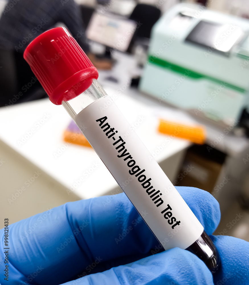 Blood sample for Thyroid Peroxidase Antibodies or Anti-TPO test and ...