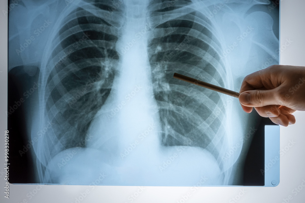 X-ray of the lungs. Chest x-ray. Doctor's view of the lung image in the ...