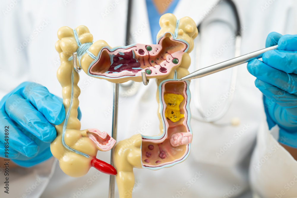 Ulcerative Colitis. Intestine, appendix and digestive system, doctor ...