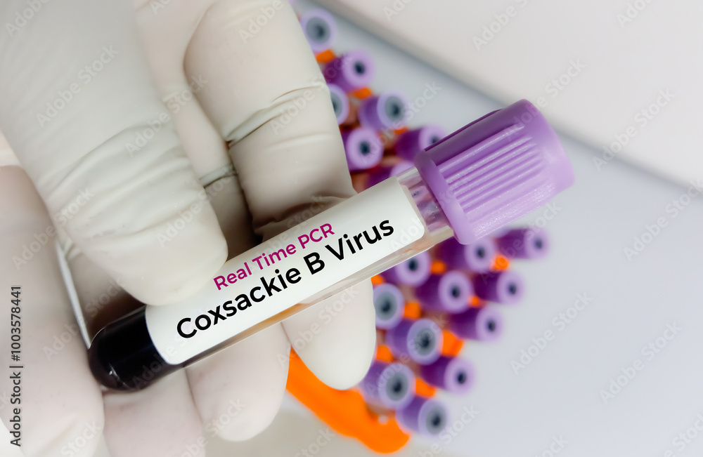 Blood sample for Hand foot and mouth disease (HFMD) test. It is a ...